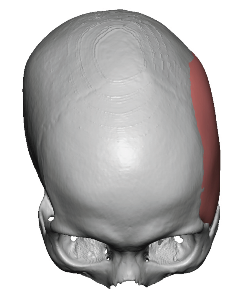 Plastic Surgery Case Study - Custom Skull Implant for Lop Sided Head ...