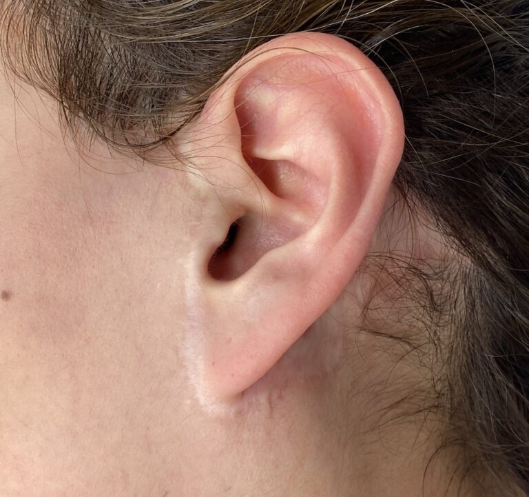 Plastic Surgery Case Study - Pixie Ear Correction in the Young Female Facelift Patient - Explore ...