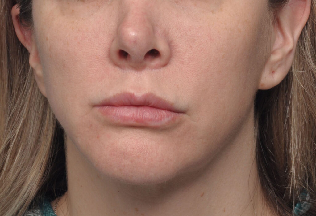 Plastic Surgery Case Study - Custom Female Infraorbital-Malar and ...