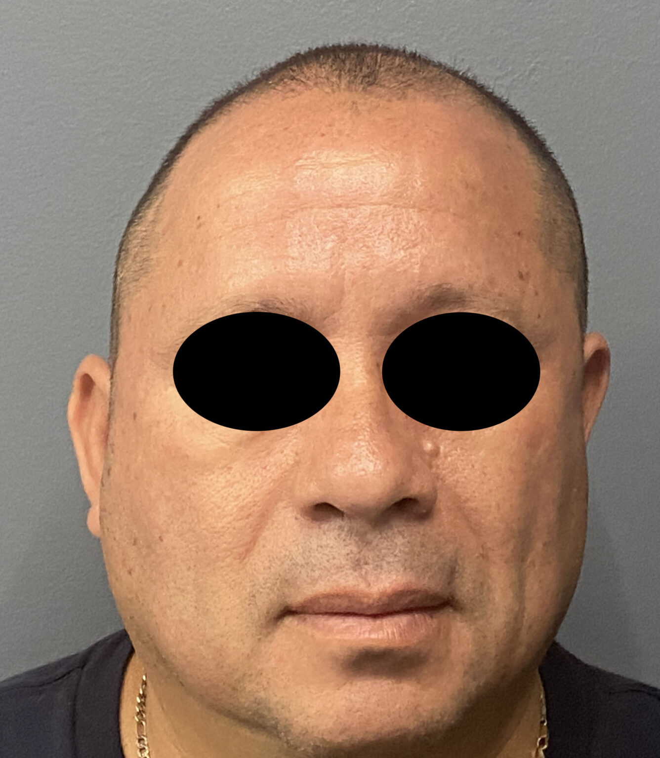 Plastic Surgery Case Study - Correction of Right Lopsided Head Shape ...