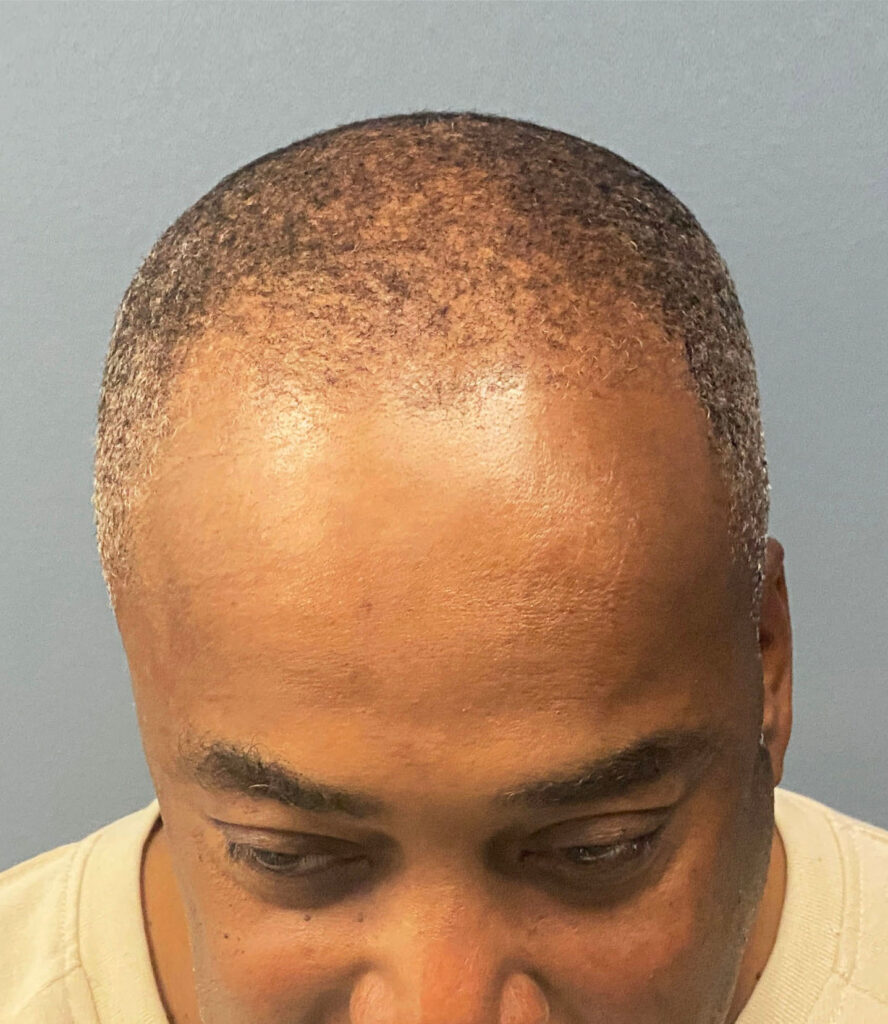 Plastic Surgery Case Study - Custom Skull Implant for Lop Sided Head ...