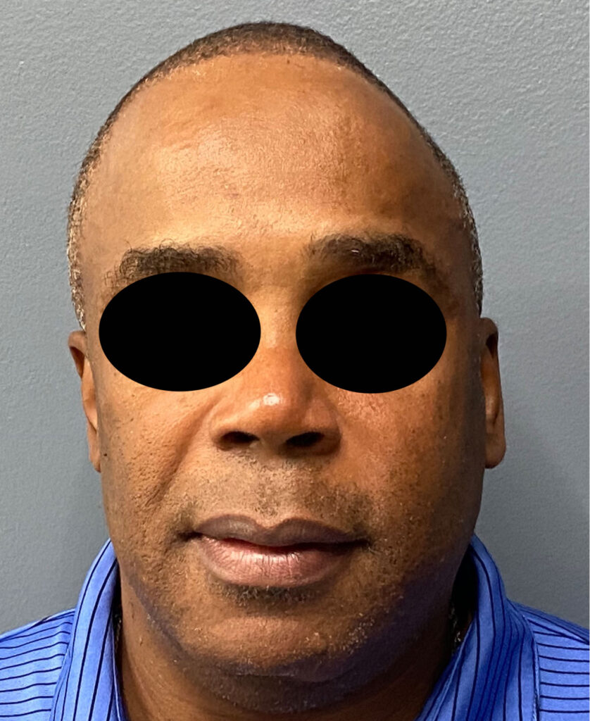 Plastic Surgery Case Study - Custom Skull Implant for Lop Sided Head ...