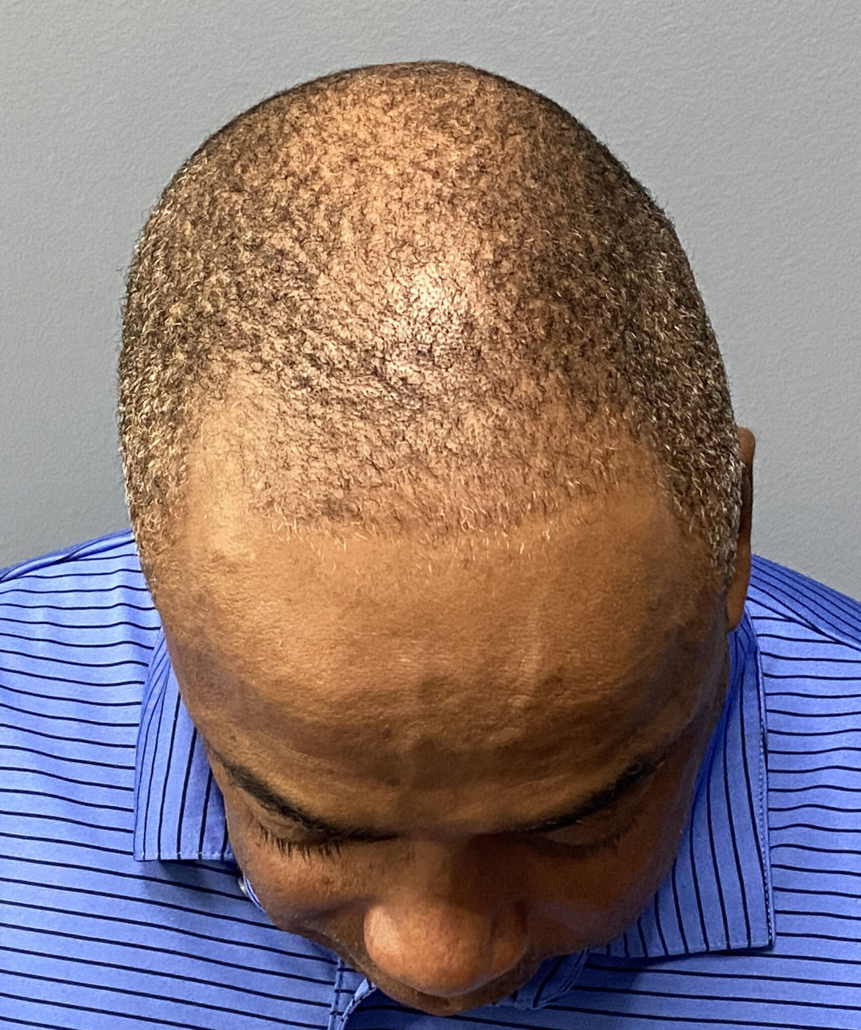 Plastic Surgery Case Study - Custom Skull Implant for Lop Sided Head ...