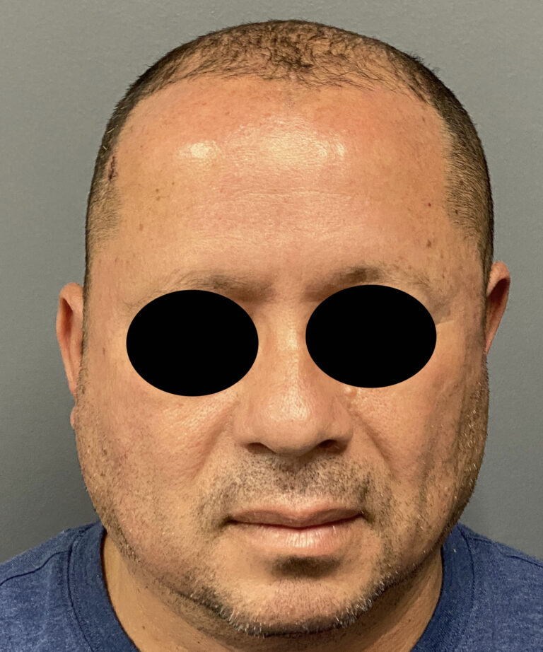 Plastic Surgery Case Study - Correction of Right Lopsided Head Shape ...