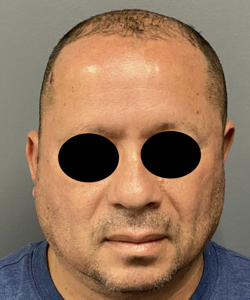 Plastic Surgery Case Study - Correction of Right Lopsided Head Shape ...