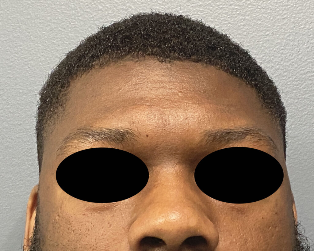 Plastic Surgery Case Study - Reduction of a Male Unilateral Bony ...