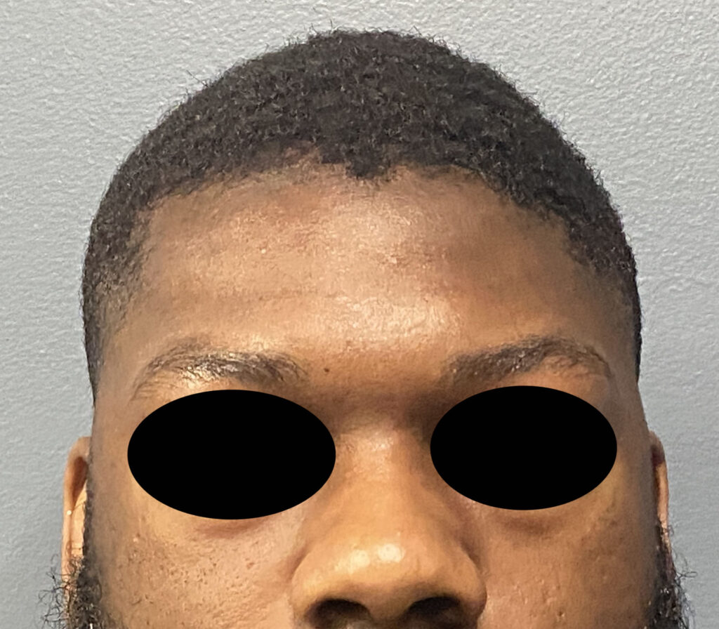 Plastic Surgery Case Study - Reduction of a Male Unilateral Bony ...