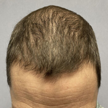 skull reshaping Archives - Explore Plastic Surgery