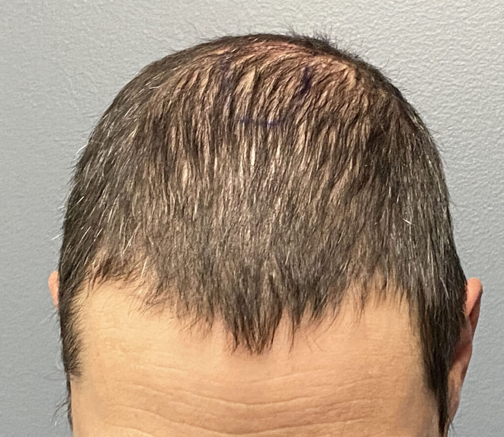 Plastic Surgery Case Study - Sagittal Crest Skull Reduction Using A ...