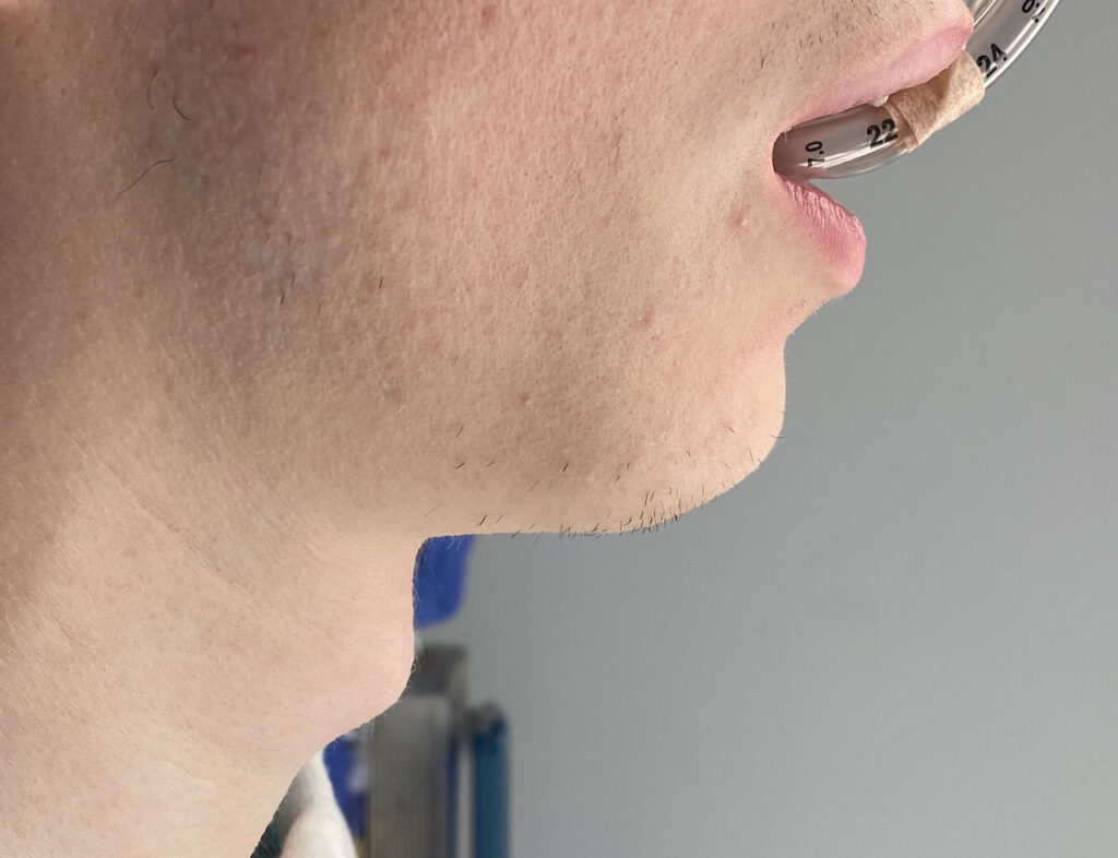 Plastic Surgery Case Study - Triple Genioplasty for Improved Aesthetic ...