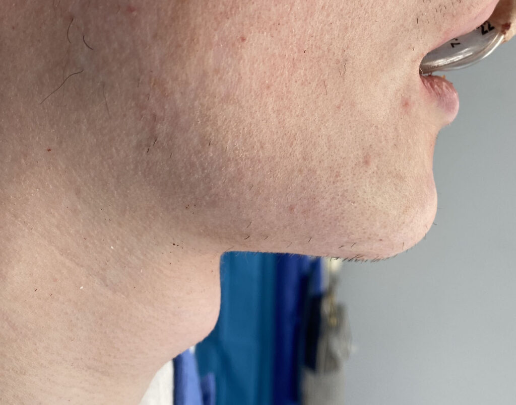 Plastic Surgery Case Study - Triple Genioplasty for Improved Aesthetic ...