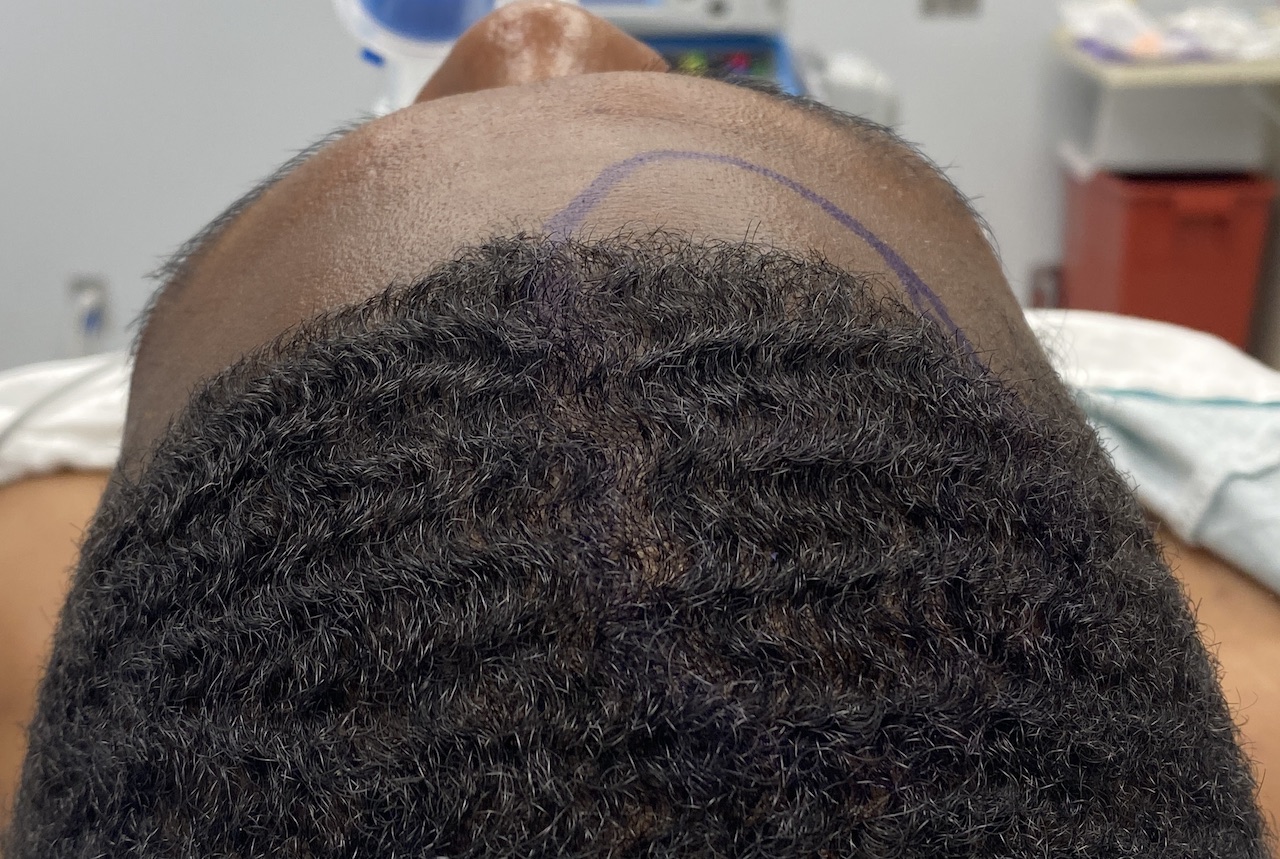 Plastic Surgery Case Study - Reduction of a Male Unilateral Bony ...