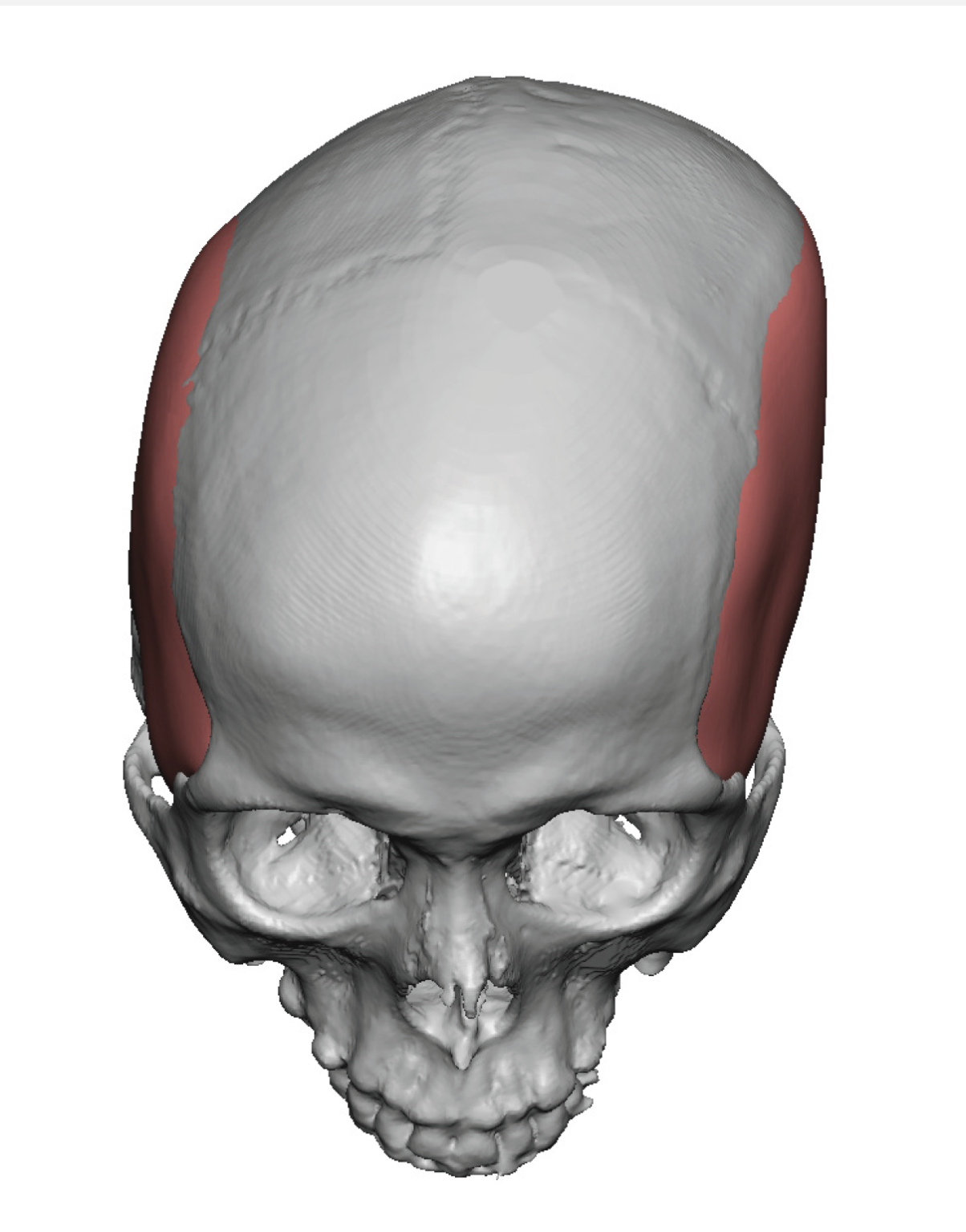 Plastic Surgery Case Study - Correction of Right Lopsided Head Shape ...