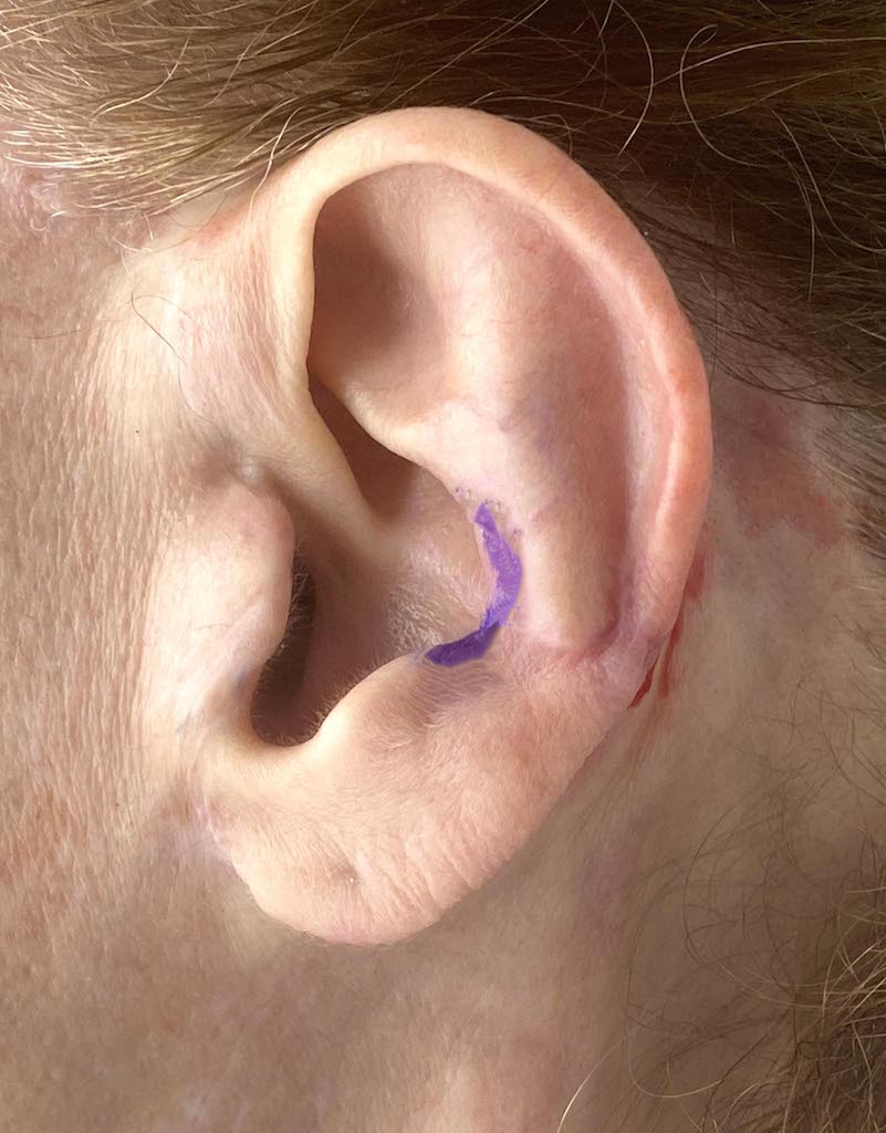 Plastic Surgery Case Study - 2nd Stage Mid Vertical Ear Reduction with ...