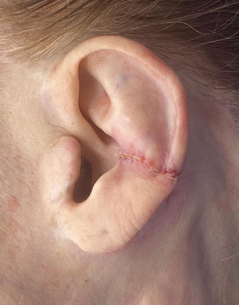 Plastic Surgery Case Study - 2nd Stage Mid Vertical Ear Reduction with ...
