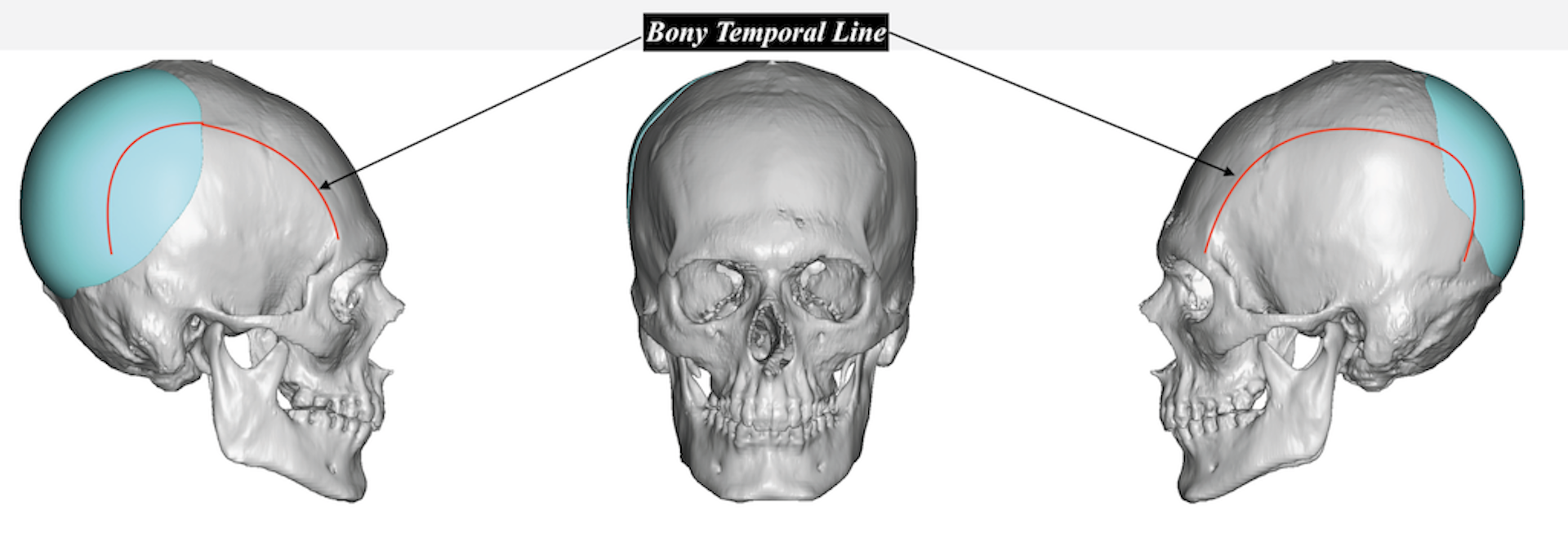Bony Temporal Line and Back of Head Skull Implants Dr Barry Eppley ...