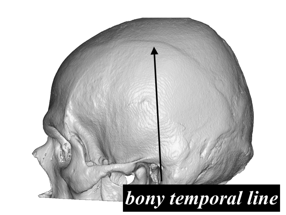 Cause of Unilateral Temporal-Eye Swelling and Bruising After Custom ...