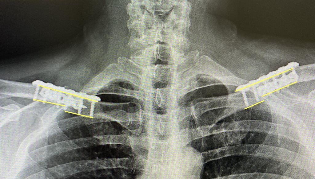 Plastic Surgery Case Study - Clavicle Bone Size Differences Across The ...