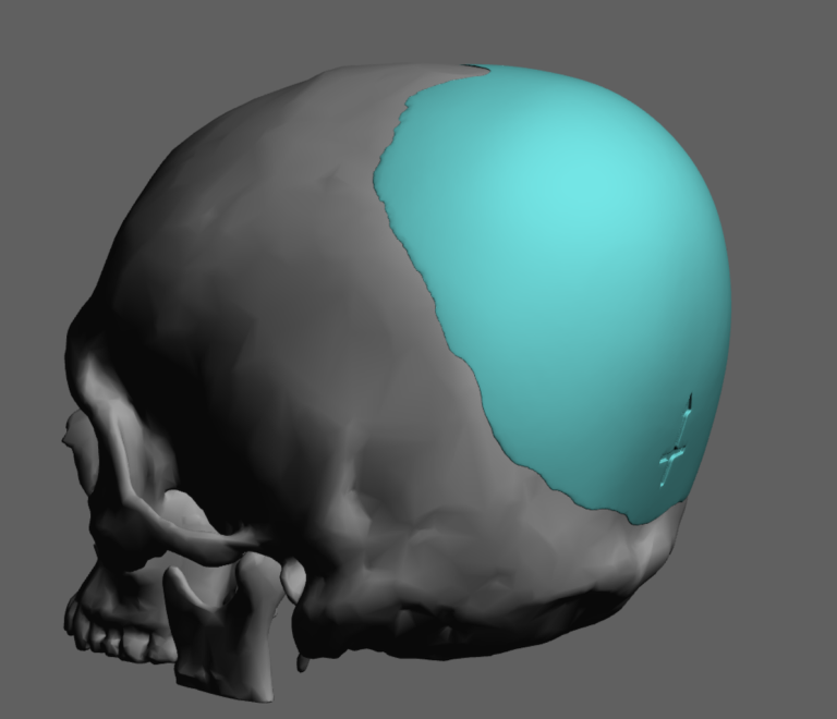Plastic Surgery Case Study - Custom Skull Implant for the Flat Back of ...