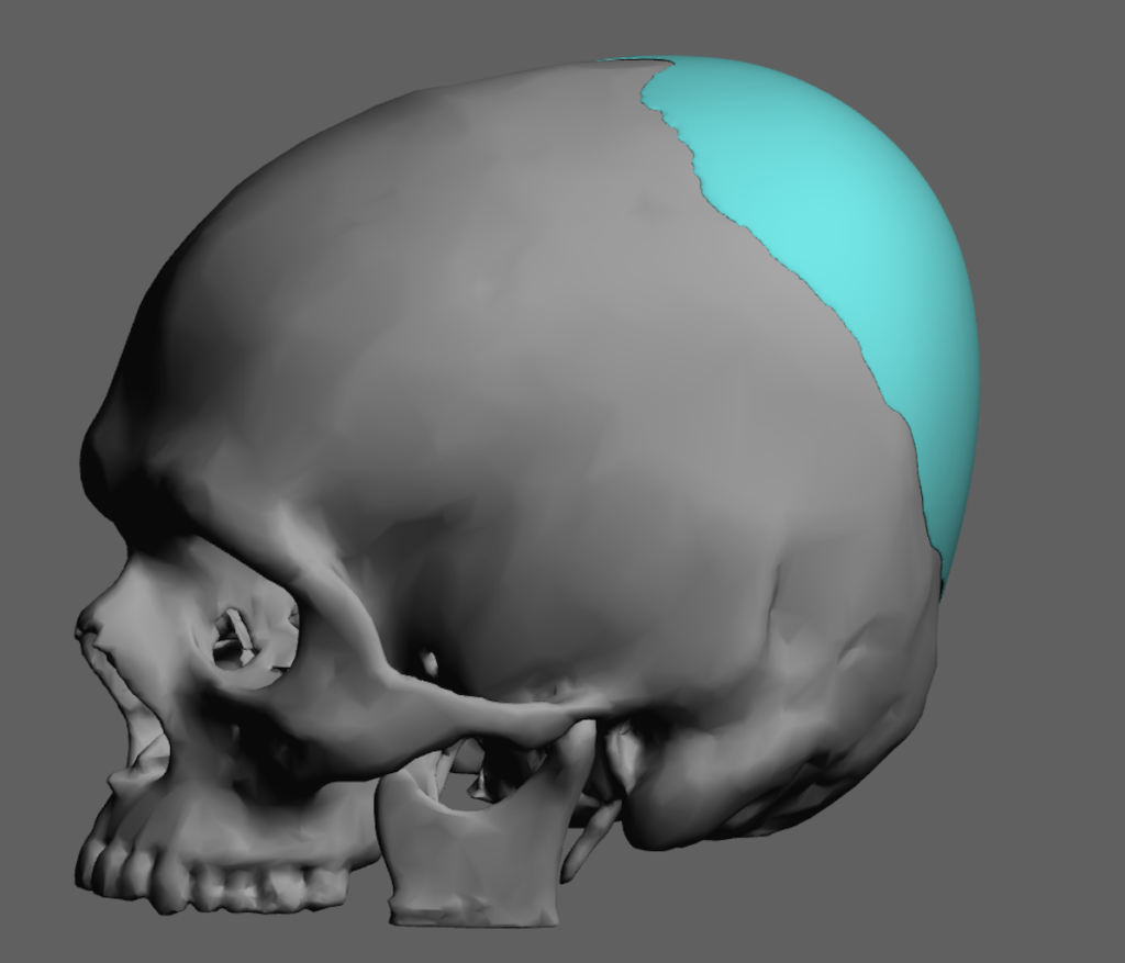 Plastic Surgery Case Study - Custom Skull Implant for the Flat Back of ...