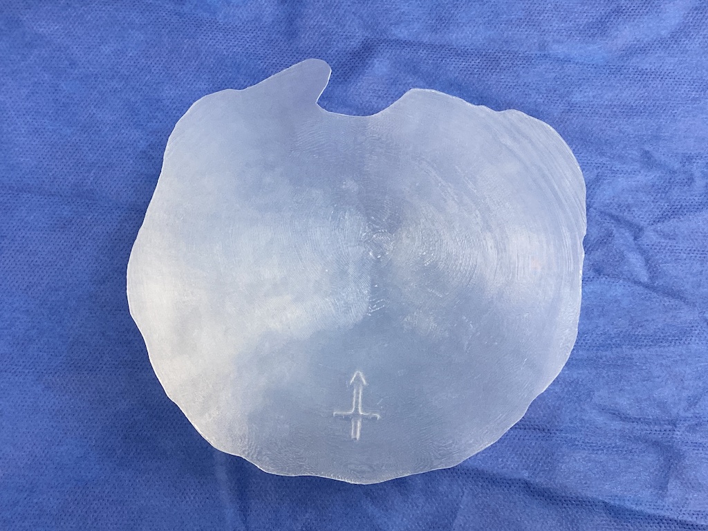 Plastic Surgery Case Study - Custom Skull Implant for the Flat Back of ...