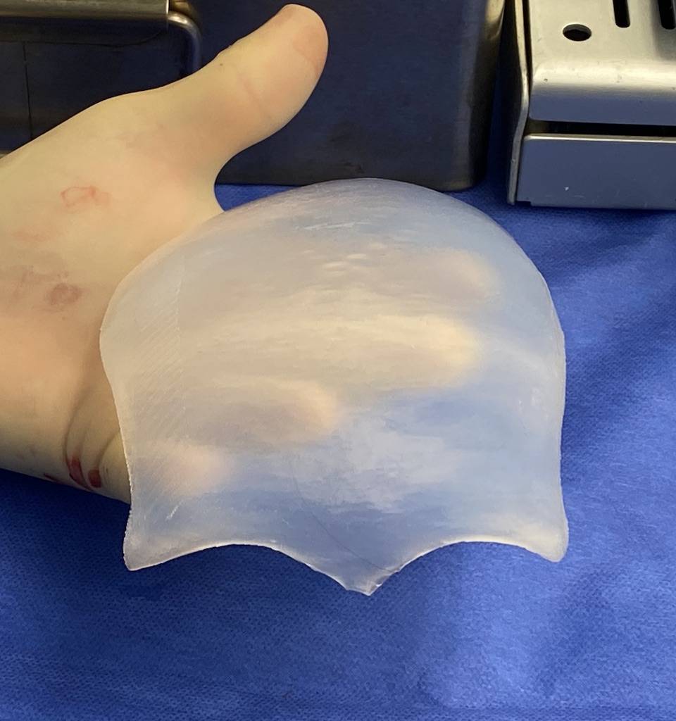 Plastic Surgery Case Study - Masculinizing the Upper Face with a Custom ...