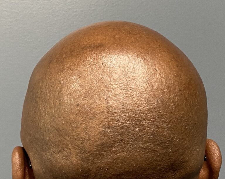 Plastic Surgery Case Study - Long Term Scalp Scar Outcome in Custom ...