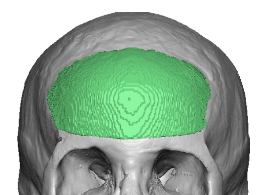 Technical Strategies - Surgical Placement of an Off-The-Shelf Forehead ...