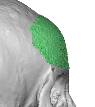 Technical Strategies - Surgical Placement of an Off-The-Shelf Forehead ...