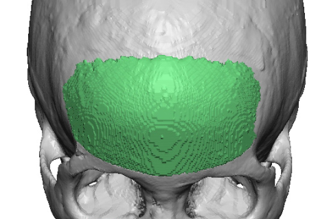 A New Off-The-Shelf Implant for Aesthetic Forehead Augmentation ...