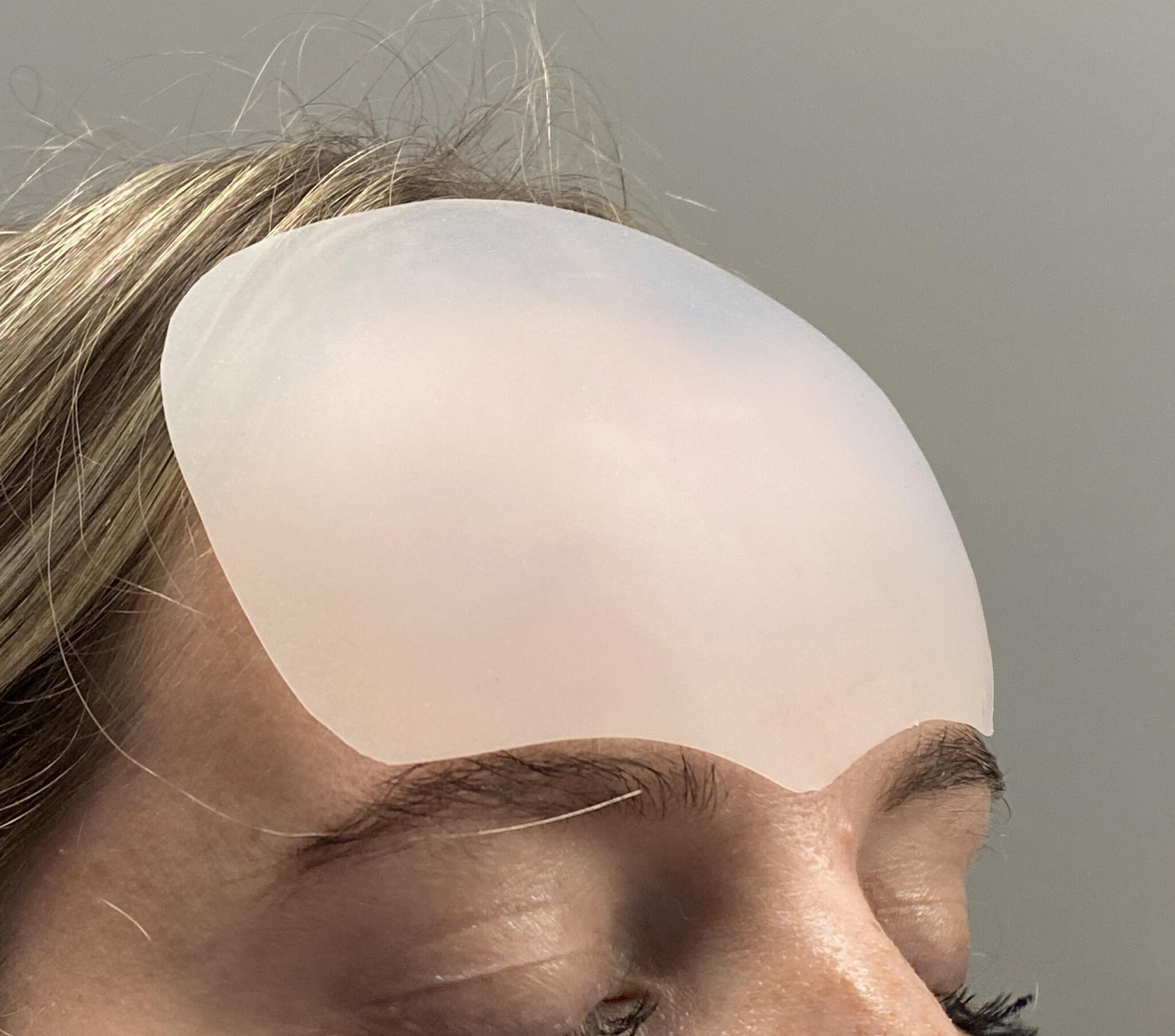 A New Off-The-Shelf Implant for Aesthetic Forehead Augmentation - Explore Plastic Surgery