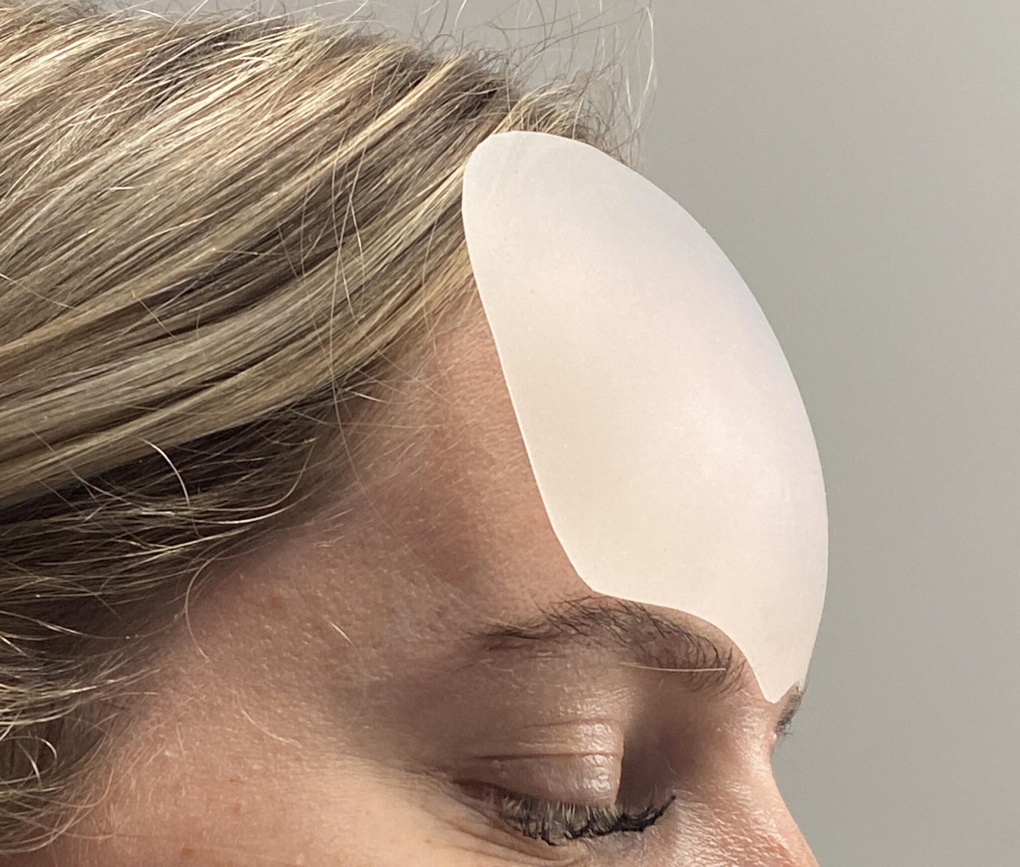 A New Off-The-Shelf Implant for Aesthetic Forehead Augmentation ...