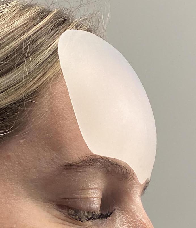 Technical Strategies - Surgical Placement of an Off-The-Shelf Forehead ...