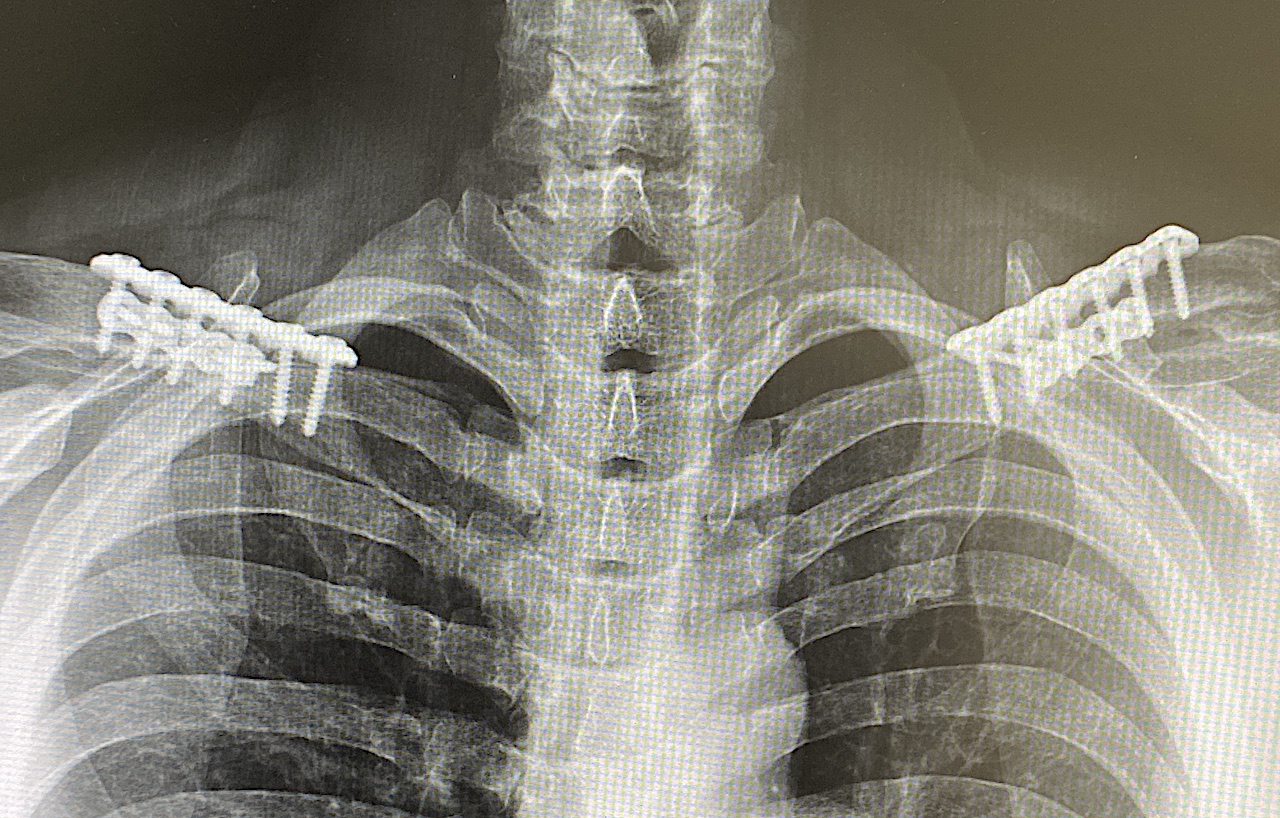 Plastic Surgery Case Study - Shoulder Reduction Surgery in Tall Females ...