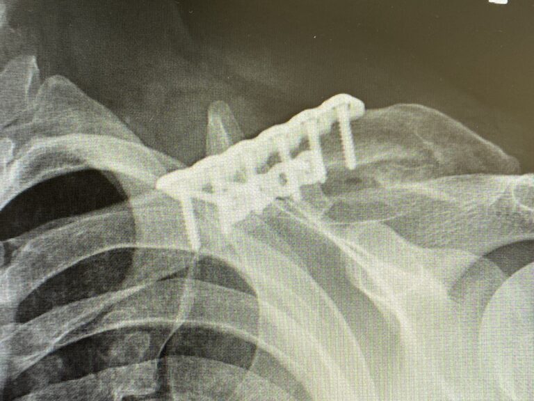 Plastic Surgery Case Study - Shoulder Reduction Surgery in Tall Females ...