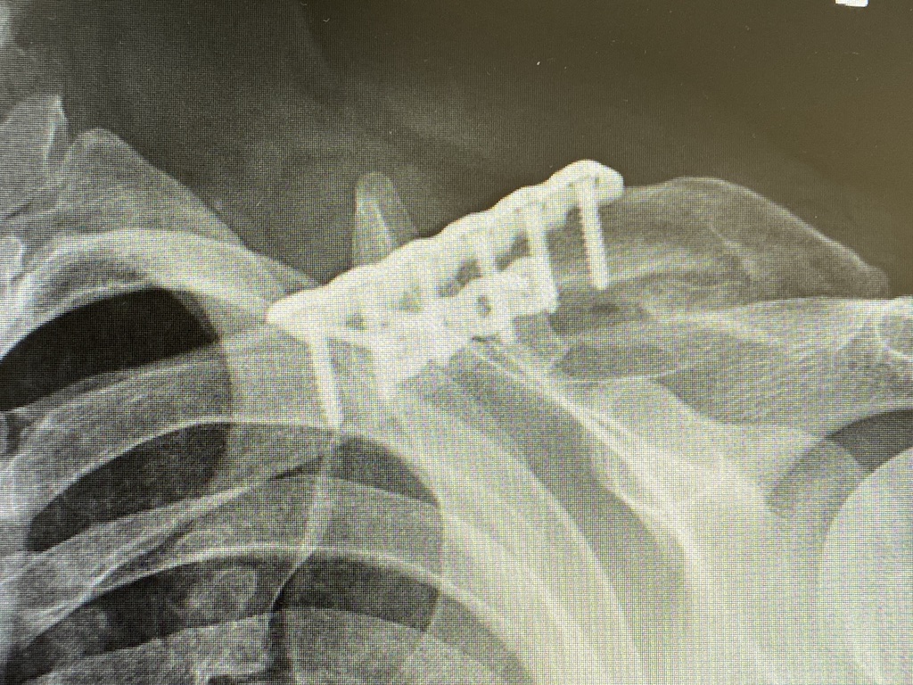 Plastic Surgery Case Study - Shoulder Reduction Surgery in Tall Females ...