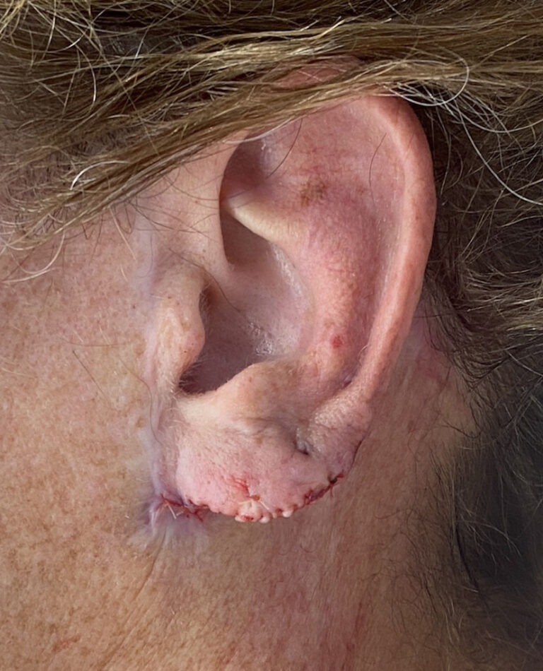 Technical Strategies - Simultaneous Earlobe Reduction and Piercing ...