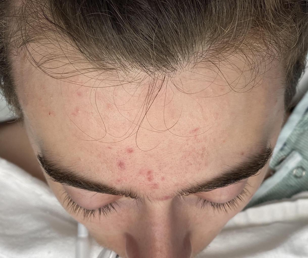 Plastic Surgery Case Study - Masculinizing the Upper Face with a Custom ...