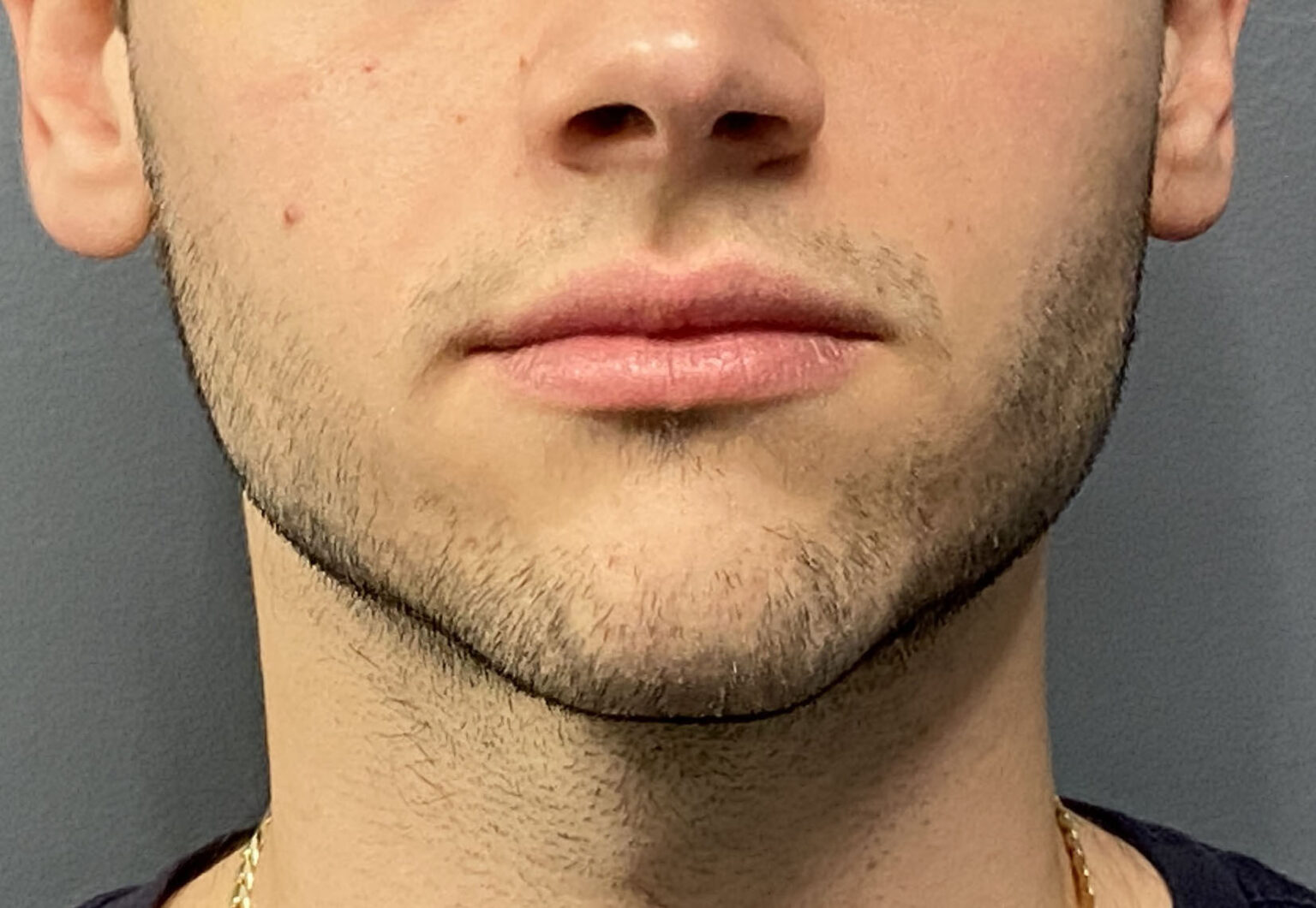 Plastic Surgery Case Study - Extended Custom Chin Implant after ...