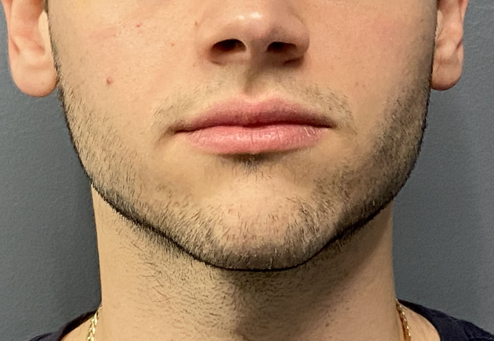 Plastic Surgery Case Study - Extended Custom Chin Implant after ...