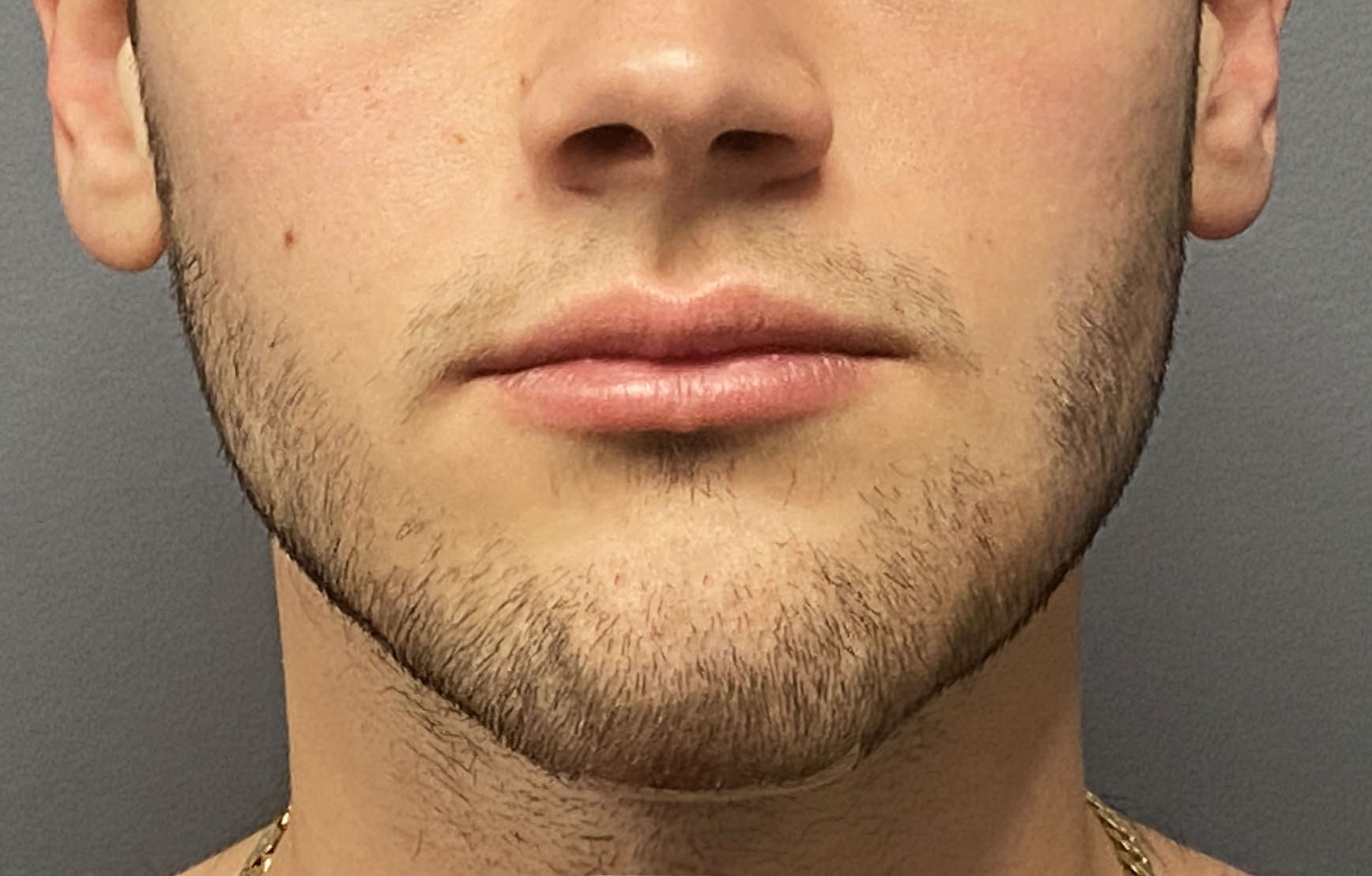 Plastic Surgery Case Study - Extended Custom Chin Implant after ...