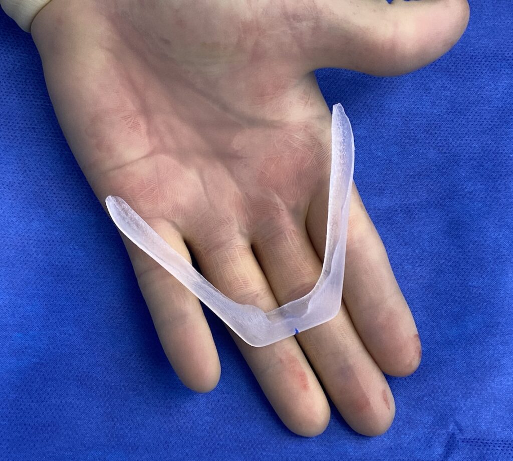 Plastic Surgery Case Study - Extended Custom Chin Implant after ...