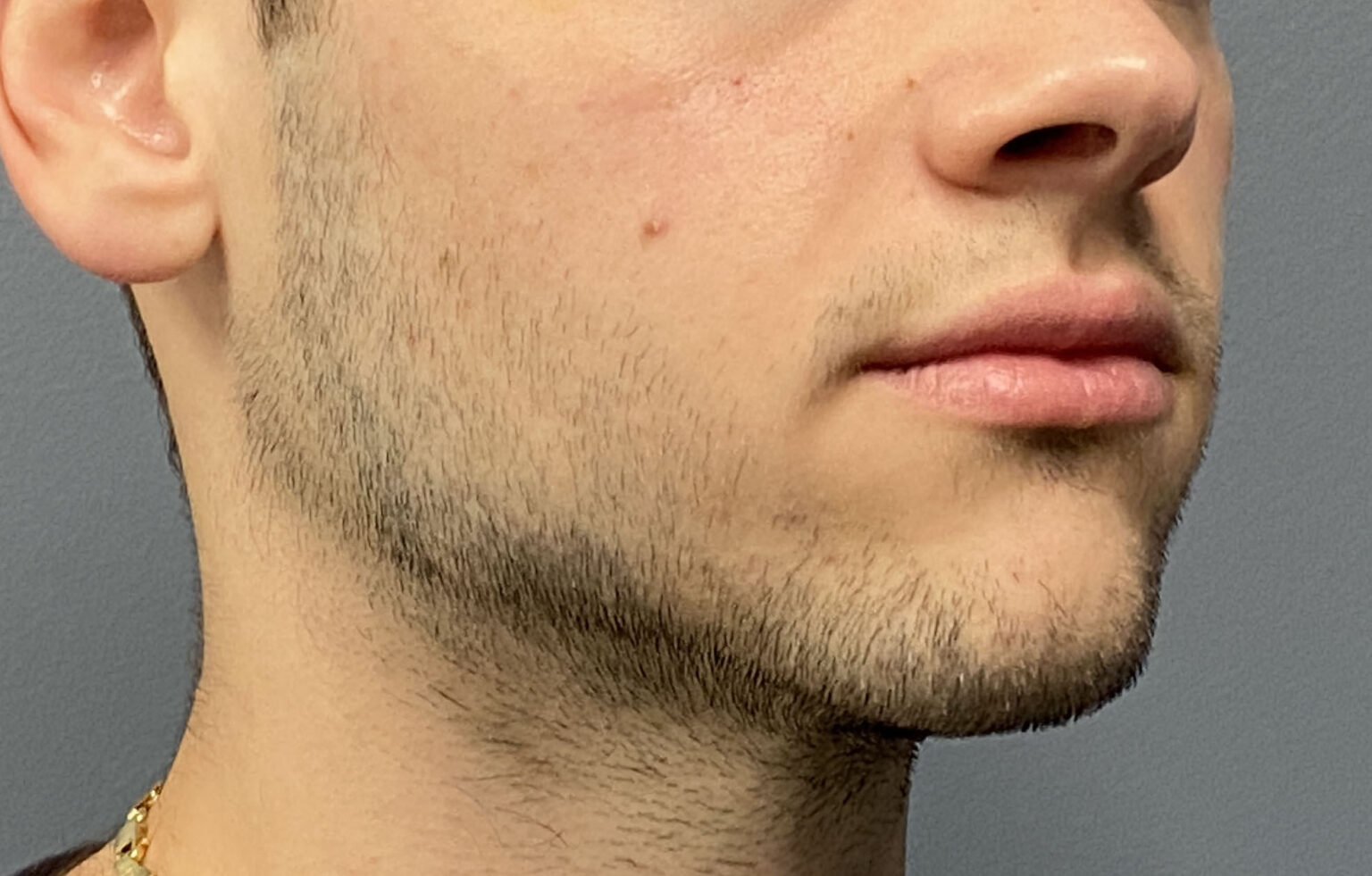 Plastic Surgery Case Study - Extended Custom Chin Implant after ...