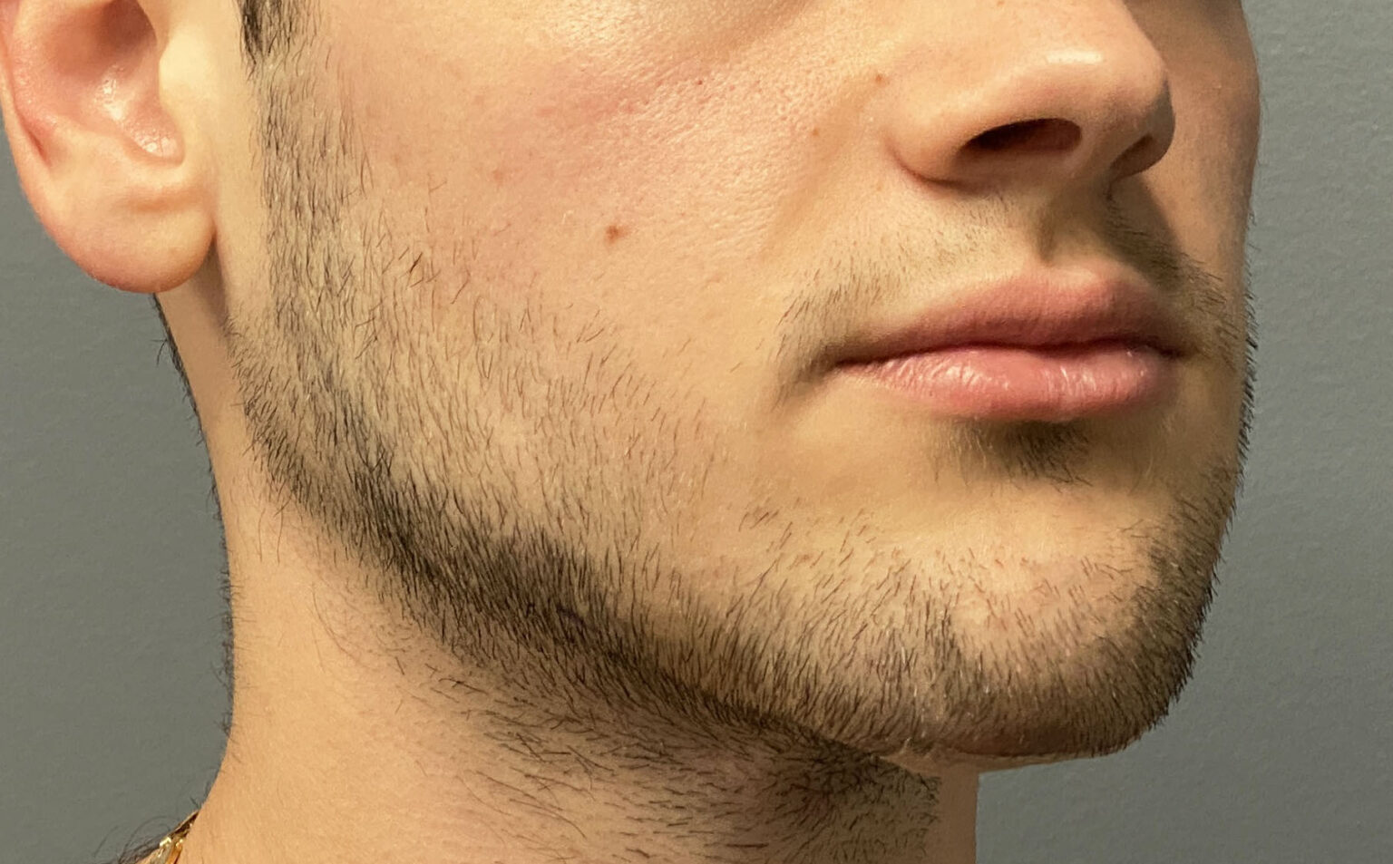 Plastic Surgery Case Study - Extended Custom Chin Implant after ...