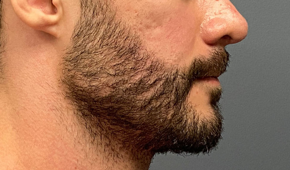 male custom jawline implangt 2 side view Dr Barry Eppley - Explore ...