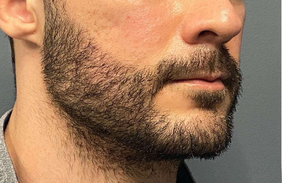 Plastic Surgery Case Study - Replacement of Custom Jawline Implant with ...