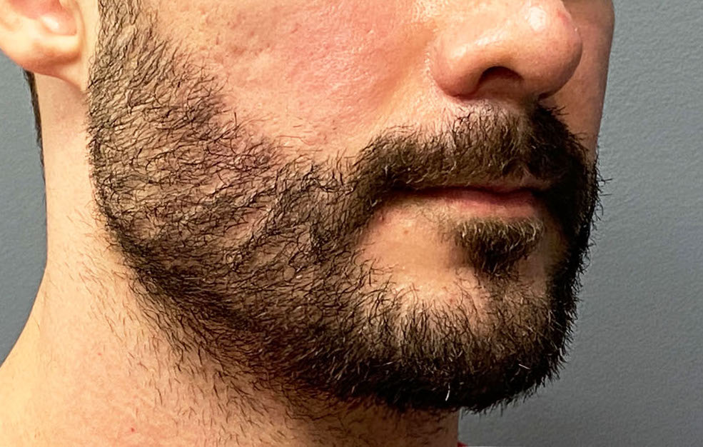 Plastic Surgery Case Study - Replacement of Custom Jawline Implant with ...