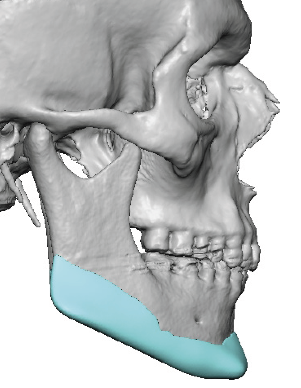 Technical Strategies - The First Step in Intraioperative Positioning of ...