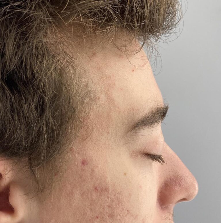 male forehead brow bone imlpant side 1 Dr Barry Eppley - Explore ...