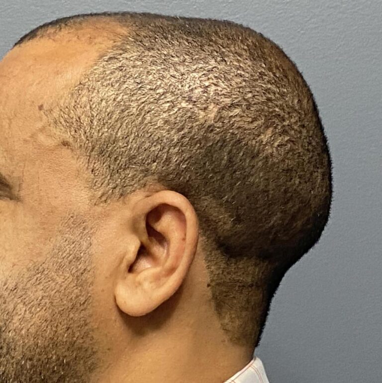 Plastic Surgery Case Study - Male Occipital Bun Skull Reduction ...
